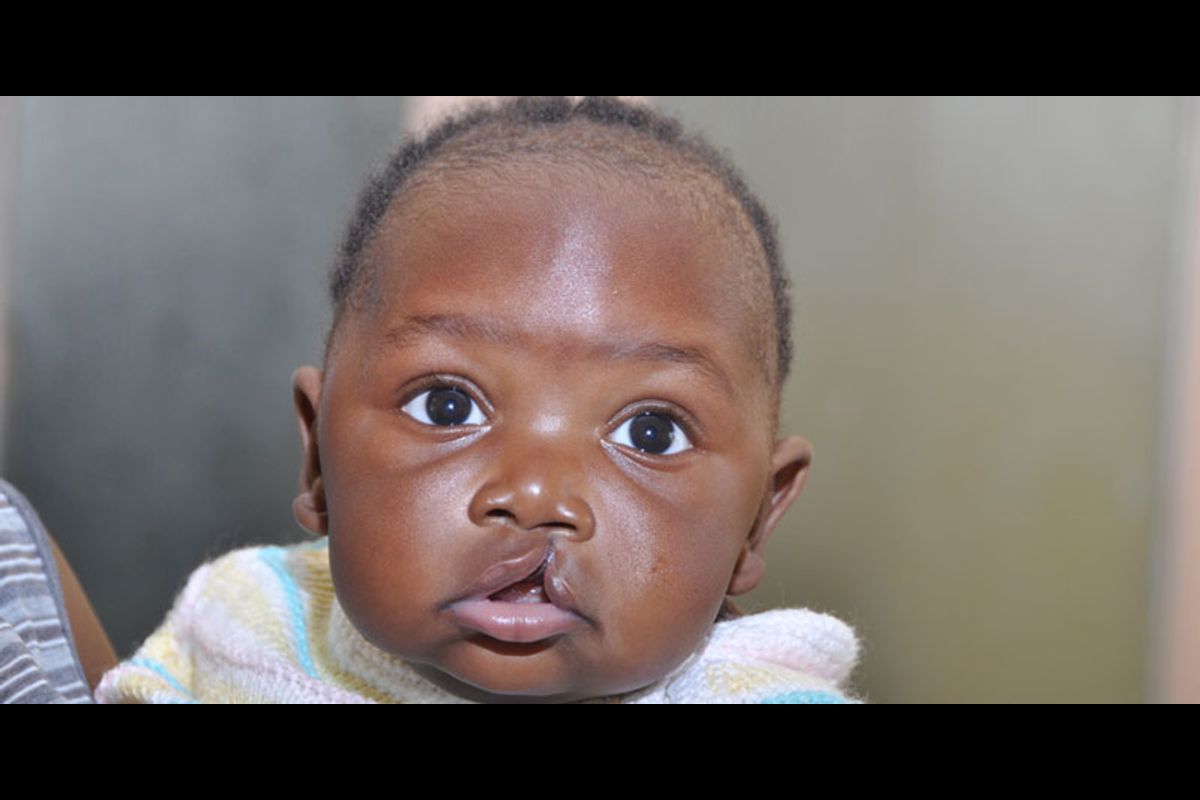 Cleft Lips and Palates: Facts, Myth, Mystery | The Sunrise Newspaper